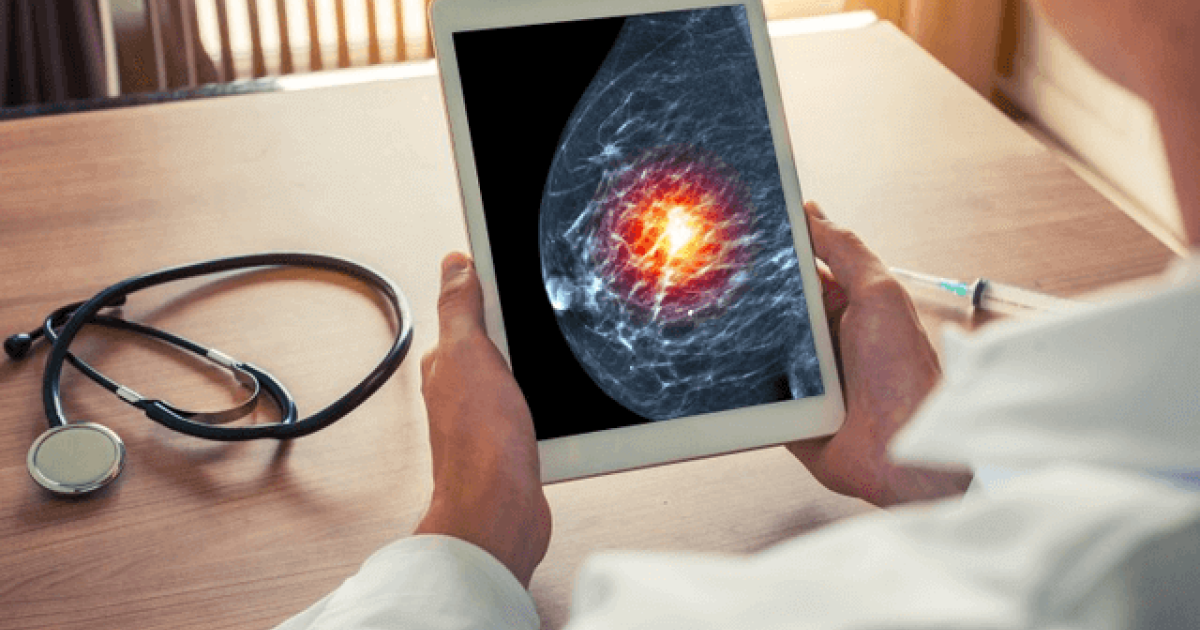 MRI vs. Mammogram for Breast Cancer Screening | AdventHealth University